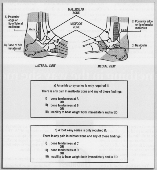 Ottawa Ankle Rules - Physio Plus